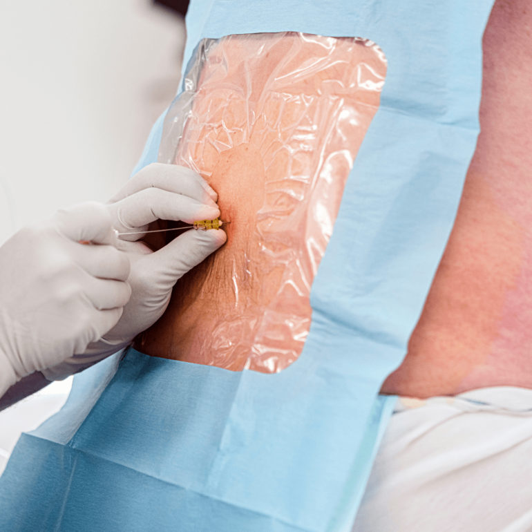 Analgesia epidural para el trabajo de parto en gestante con ...